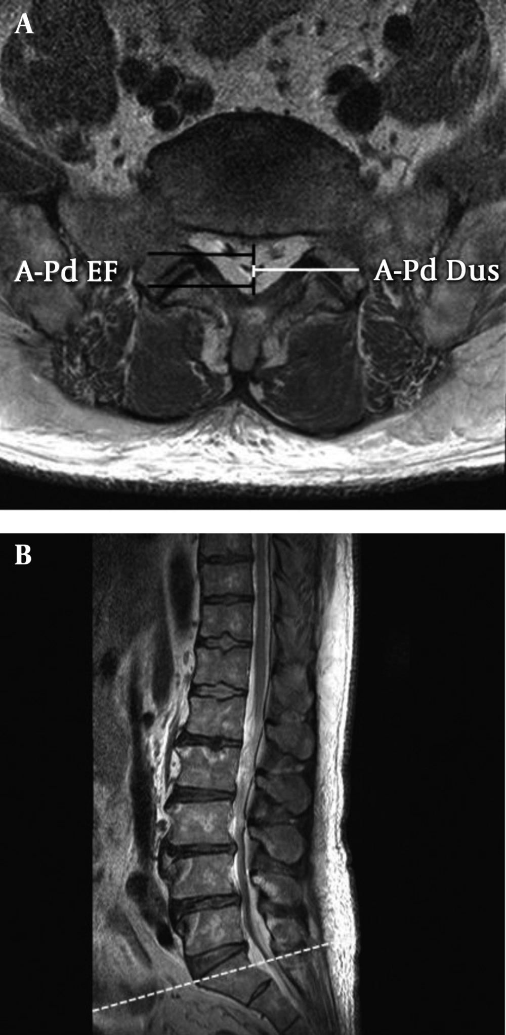Thecal Sac Compression Mri