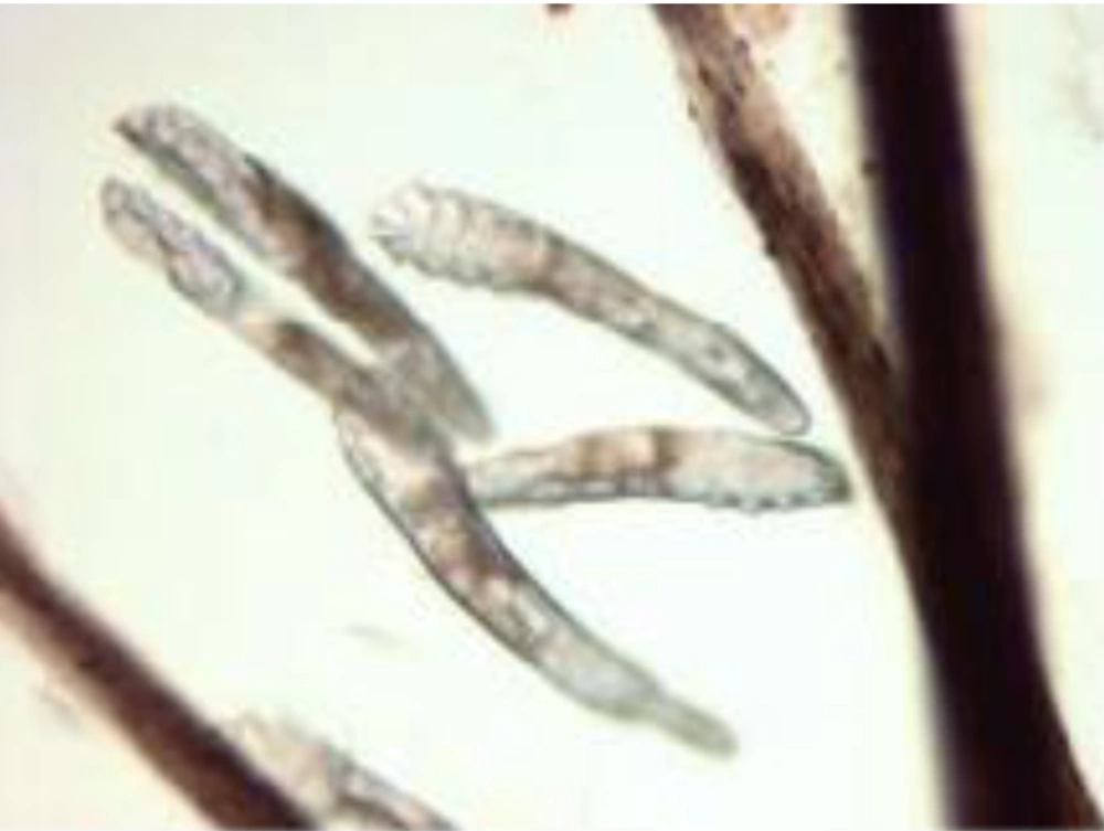 Prevalence of Demodex in Association with Ocular Signs and Symptoms ...