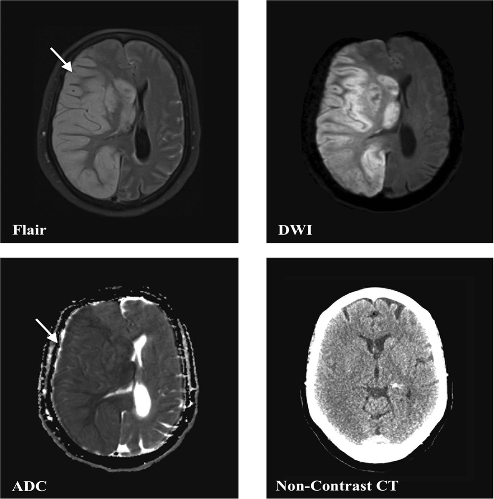Diagnostic Accuracy of Diffusion-Weighted MRI and Non-contrast CT in ...