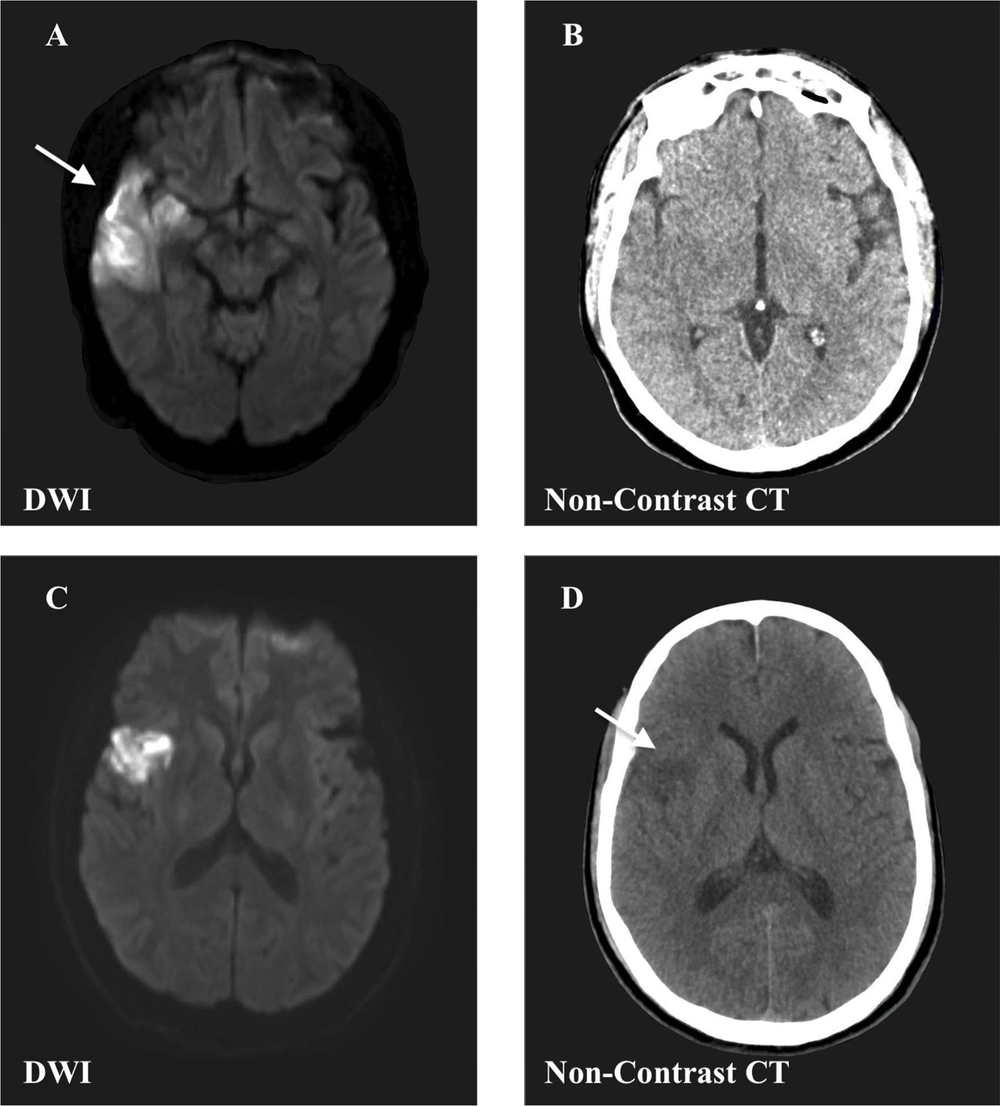 Diagnostic Accuracy of Diffusion-Weighted MRI and Non-contrast CT in ...