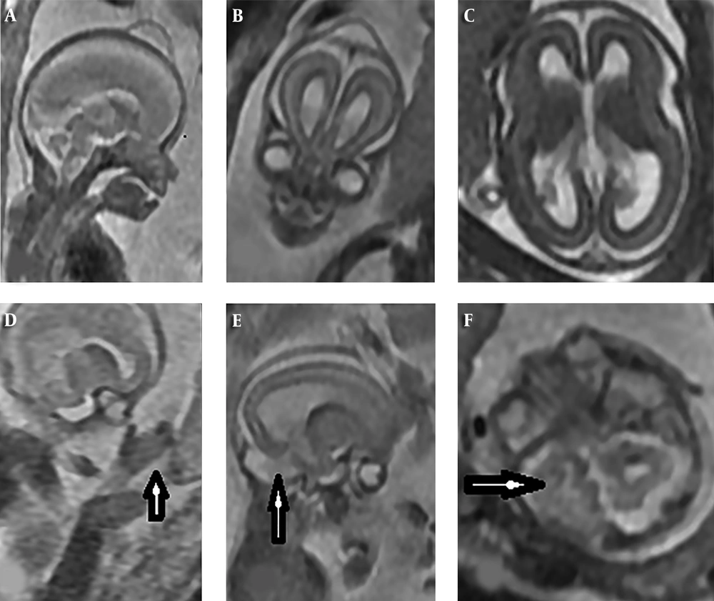 A Case of Apert Syndrome: Early Detection of Temporal Lobe ...