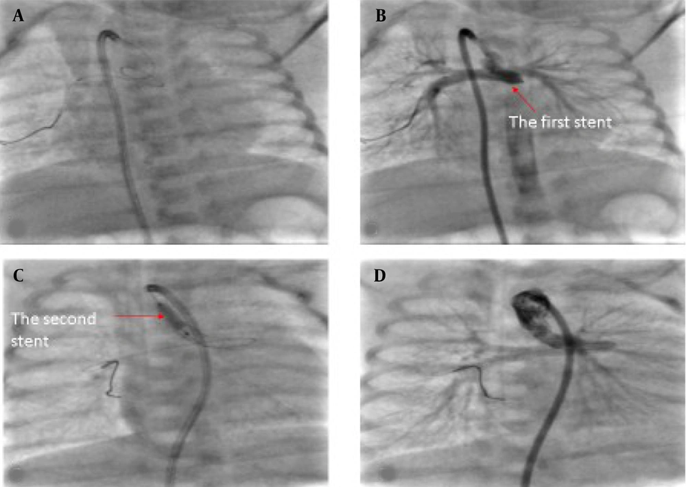 Ductus Arteriosus Stenting in Neonates with Pulmonary Valve Atresia ...