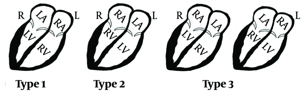 Association of Cardiac Anomalies in Pediatric Dextrocardia: A CT ...