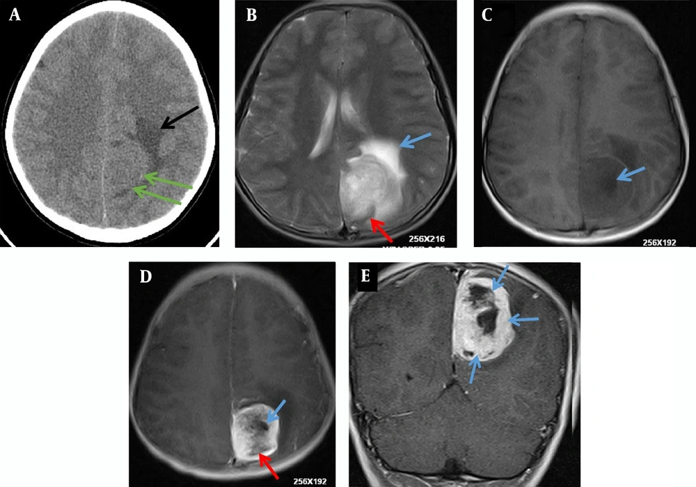 Intracranial Malignant Triton Tumor in Children: A Case Report