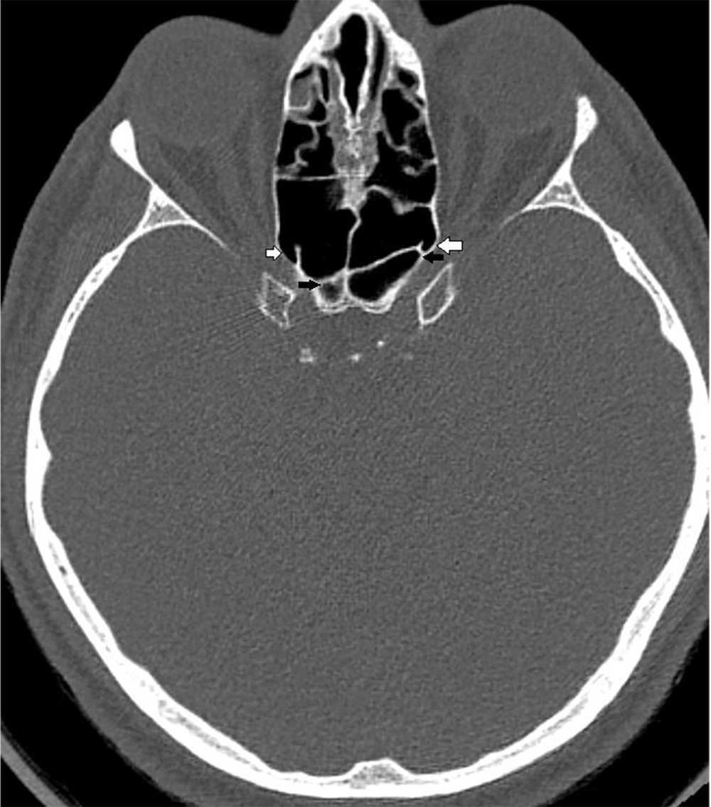 Optic Foramen View Radiology
