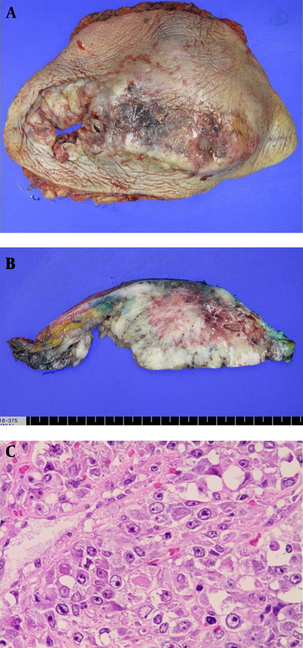 Benign Phyllodes Tumor of the Breast Recurring as a Rapidly Growing ...