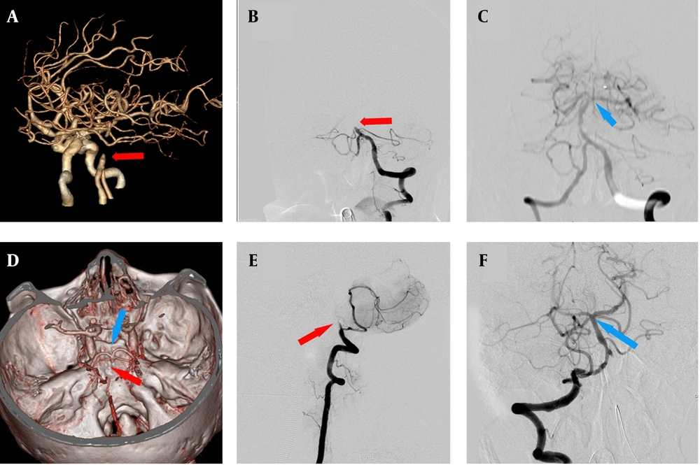 Predictive Value of Basilar Artery Apex for Prognosis of Endovascular ...