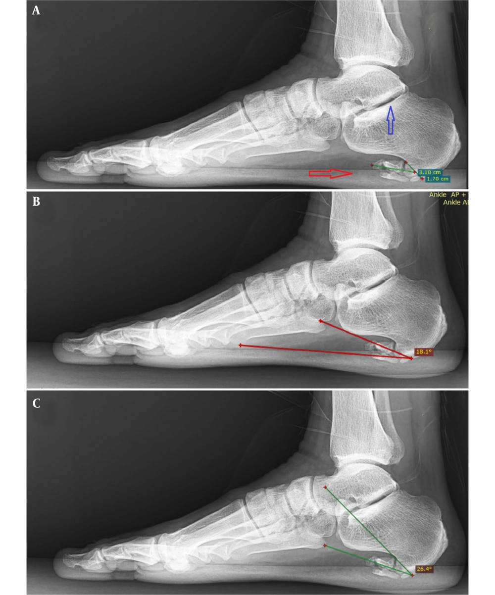 Achilles Tendon Traction Spur
