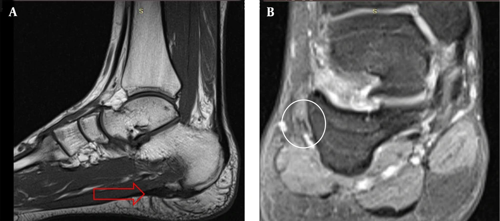 Posterior Calcaneal Spur Formation