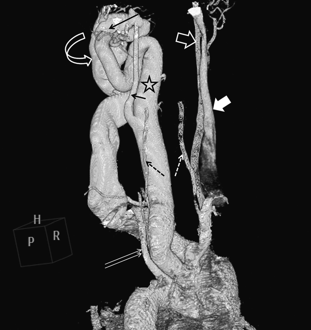Congenital External Carotid-External Jugular Arteriovenous Fistula ...