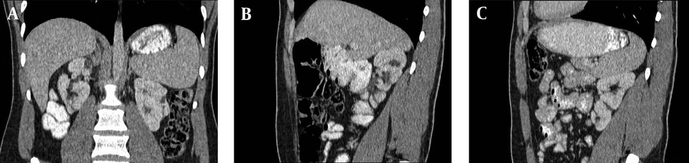 Bilateral Supernumerary Kidney: a Very Rare Presentation