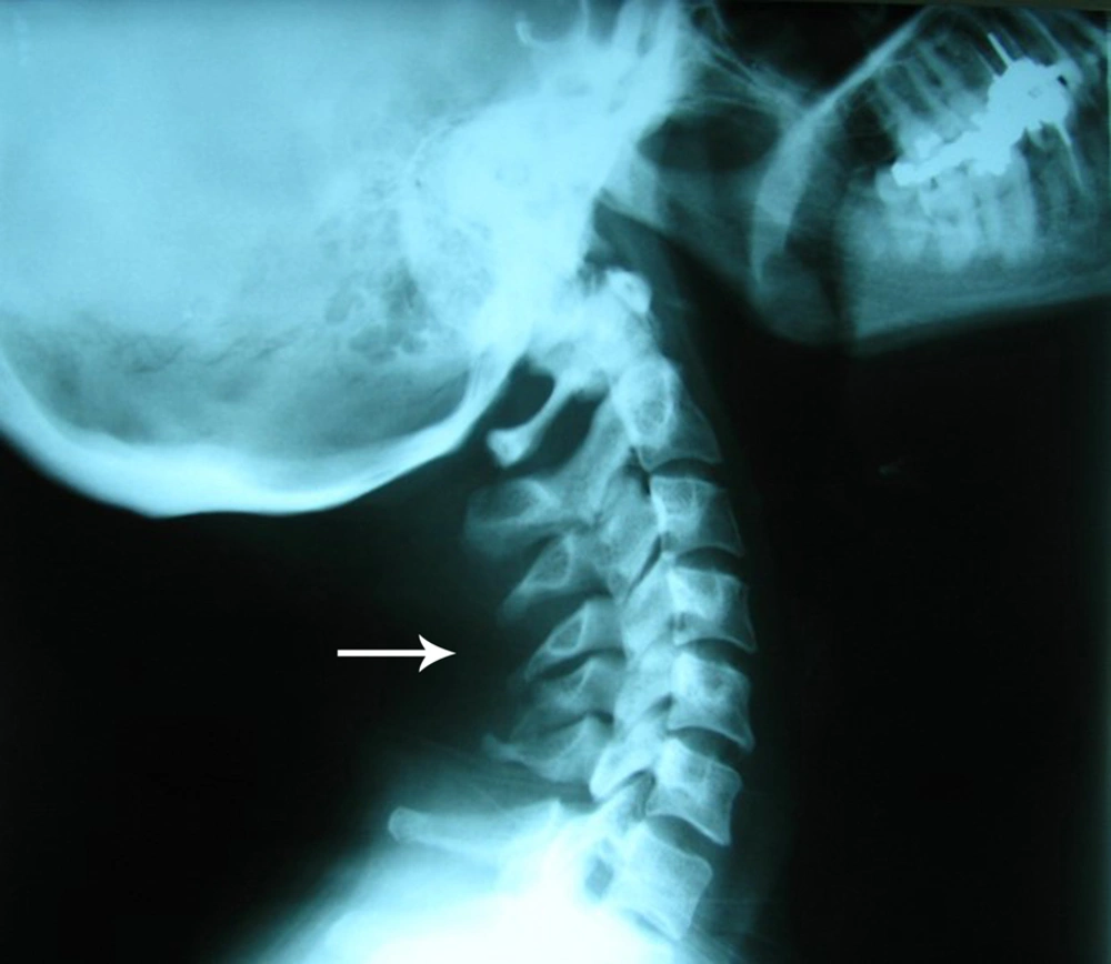 Chondromyxoid Fibroma of Two Cervical Vertebrae with Involvement of ...