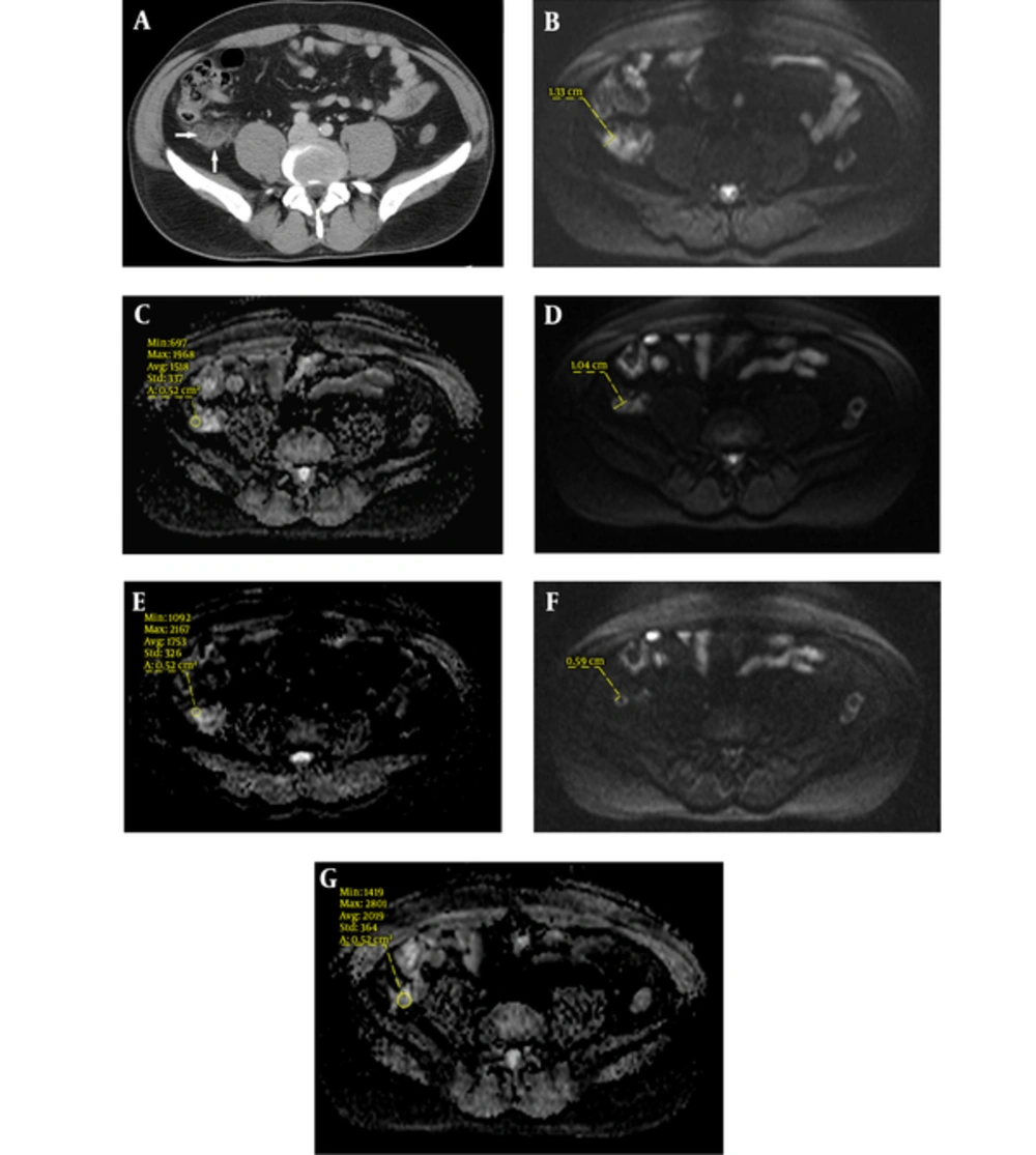 Contribution of Diffusion-Weighted Magnetic Resonance Imaging in the ...