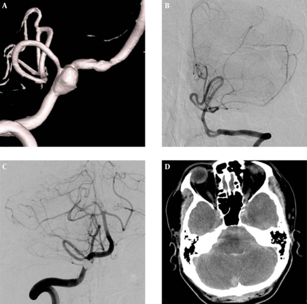 Endovascular Treatment of Ruptured Vertebral Artery Dissecting Aneurysms