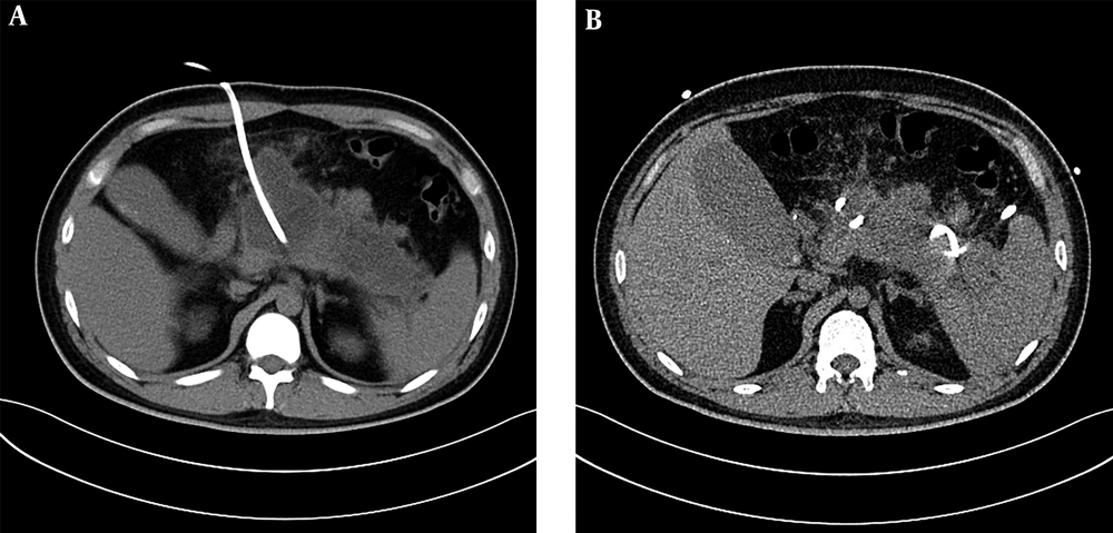 Analysis of the Treatment Efficacy of Percutaneous Catheter Drainage ...