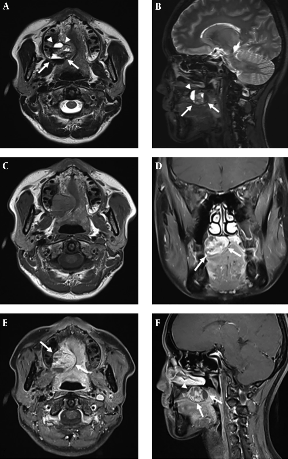 MR Imaging Characteristics of Myoepithelial Carcinoma Ex Pleomorphic ...
