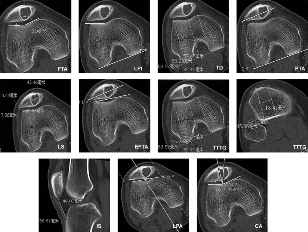 Patellofemoral Morphology and Imaging Features of Patellar Tumors and ...