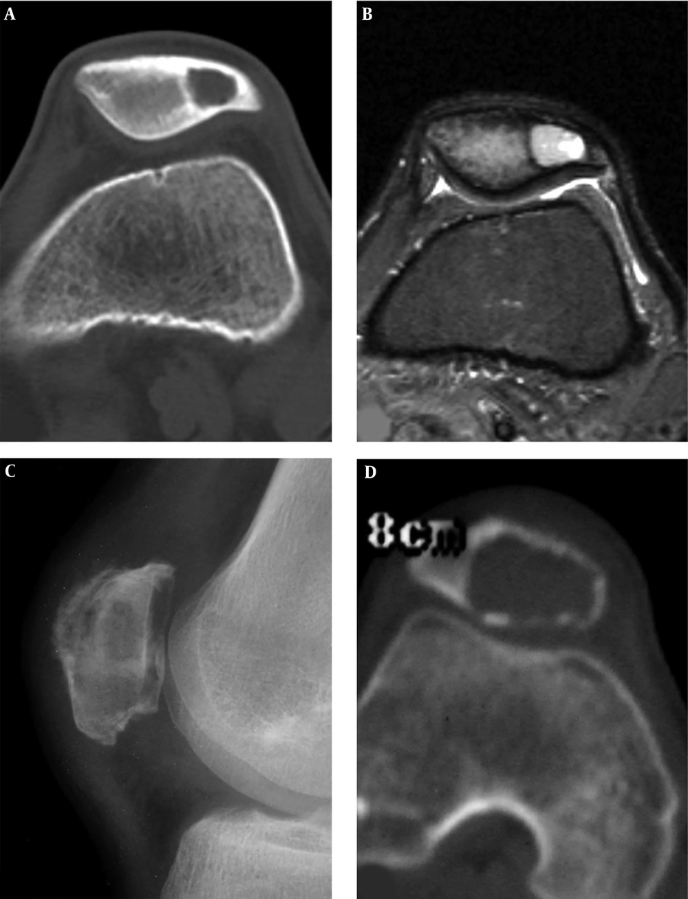 Patellofemoral Morphology and Imaging Features of Patellar Tumors and ...