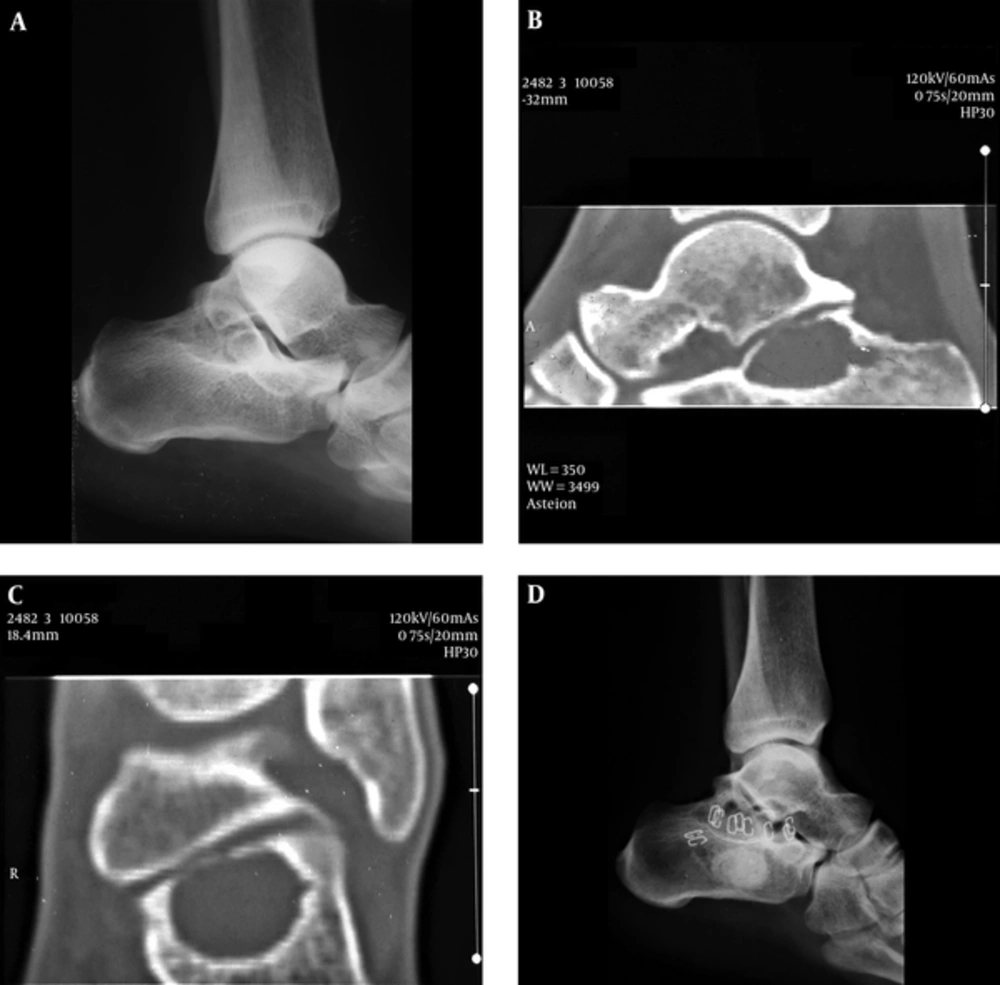 Hidden Unicameral Bone Cyst of the Calcaneus: A Case Report of Military ...