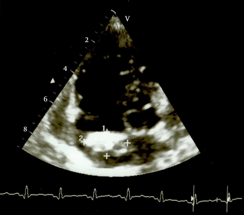 Intermittent Prolapse of Right Atrial Myxoma in a Four-Year-Old Girl