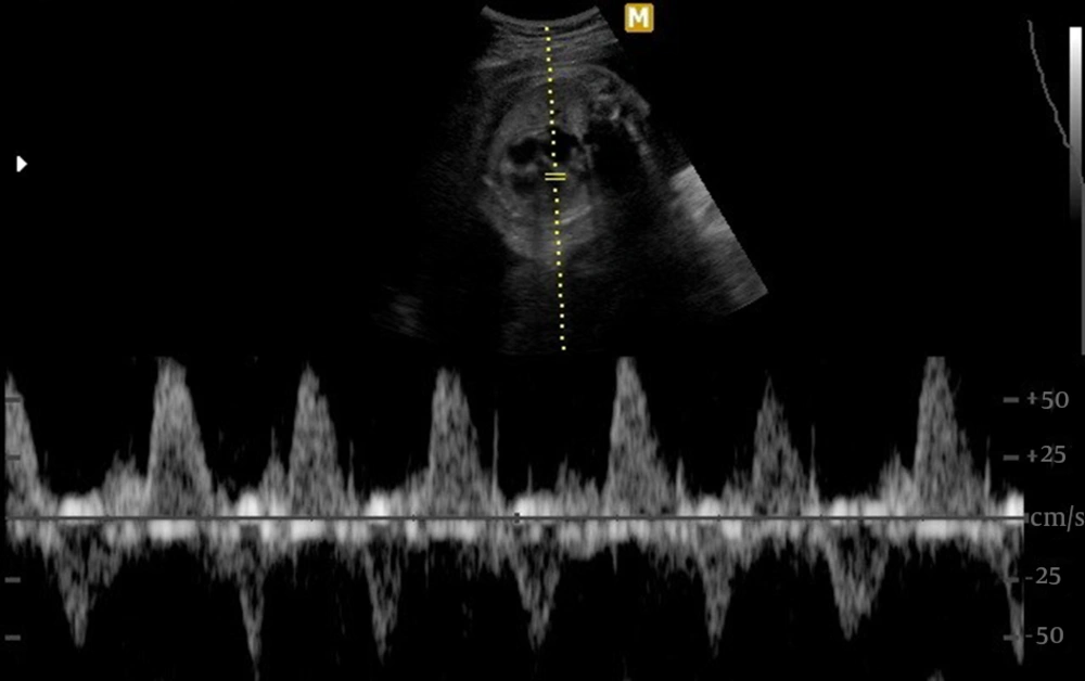 Management of Fetal Ectopic Atrial Tachycardia: What is the Best Decision?