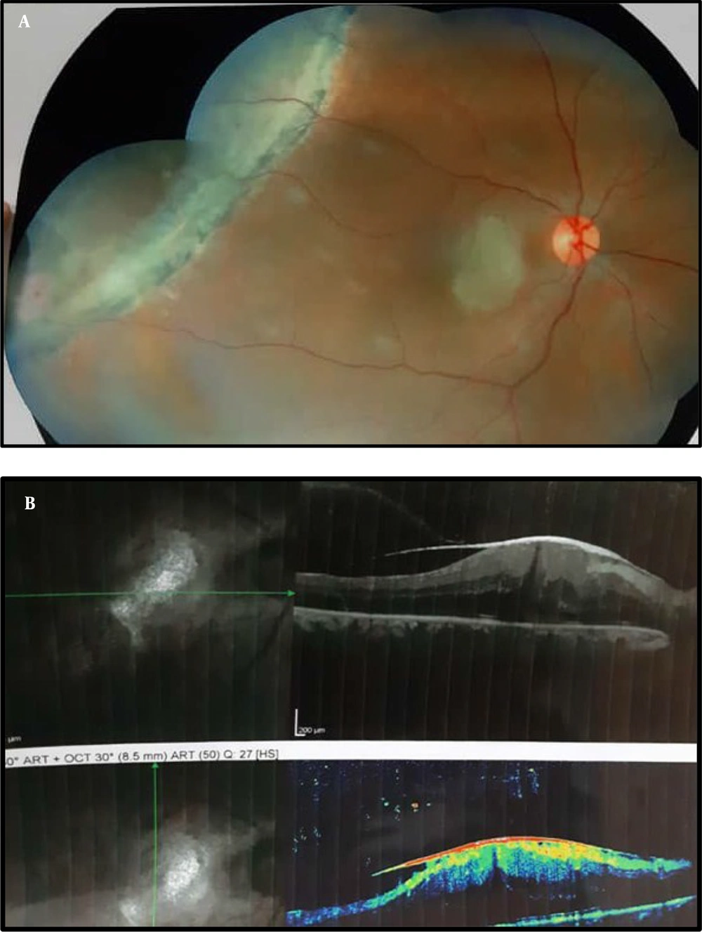 Spontaneous Separation of Secondary Epiretinal Membrane (ERM) with ...