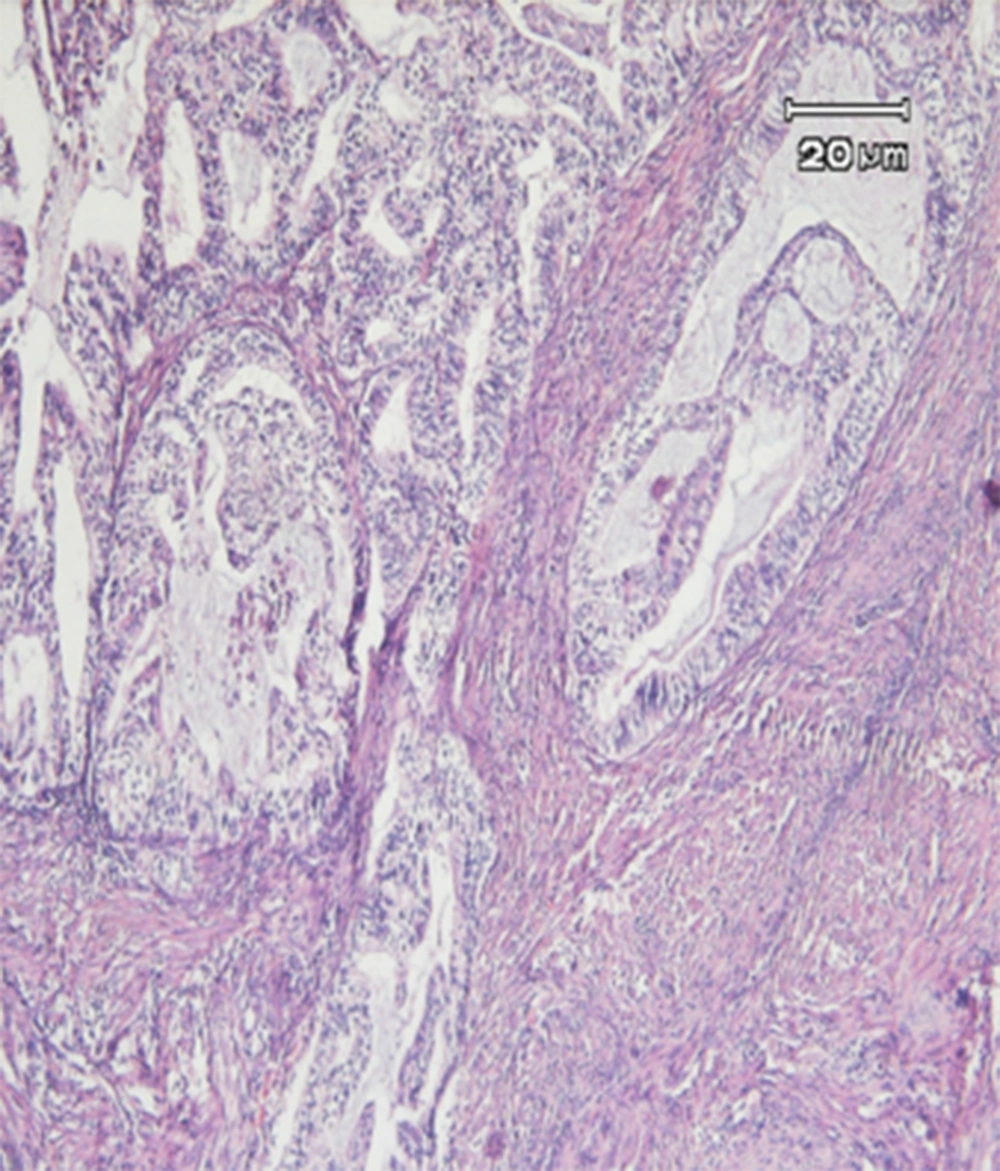 Detection of Human Papillomavirus in Chronic Cervicitis, Cervical ...