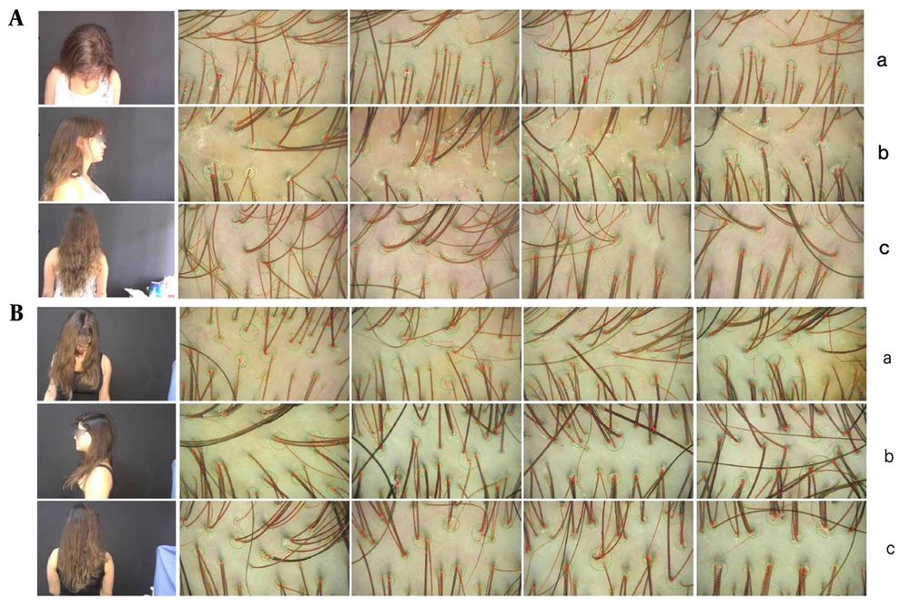 A Case Report of Microifusion of Drugs Into the Skin (MMP®) with ...
