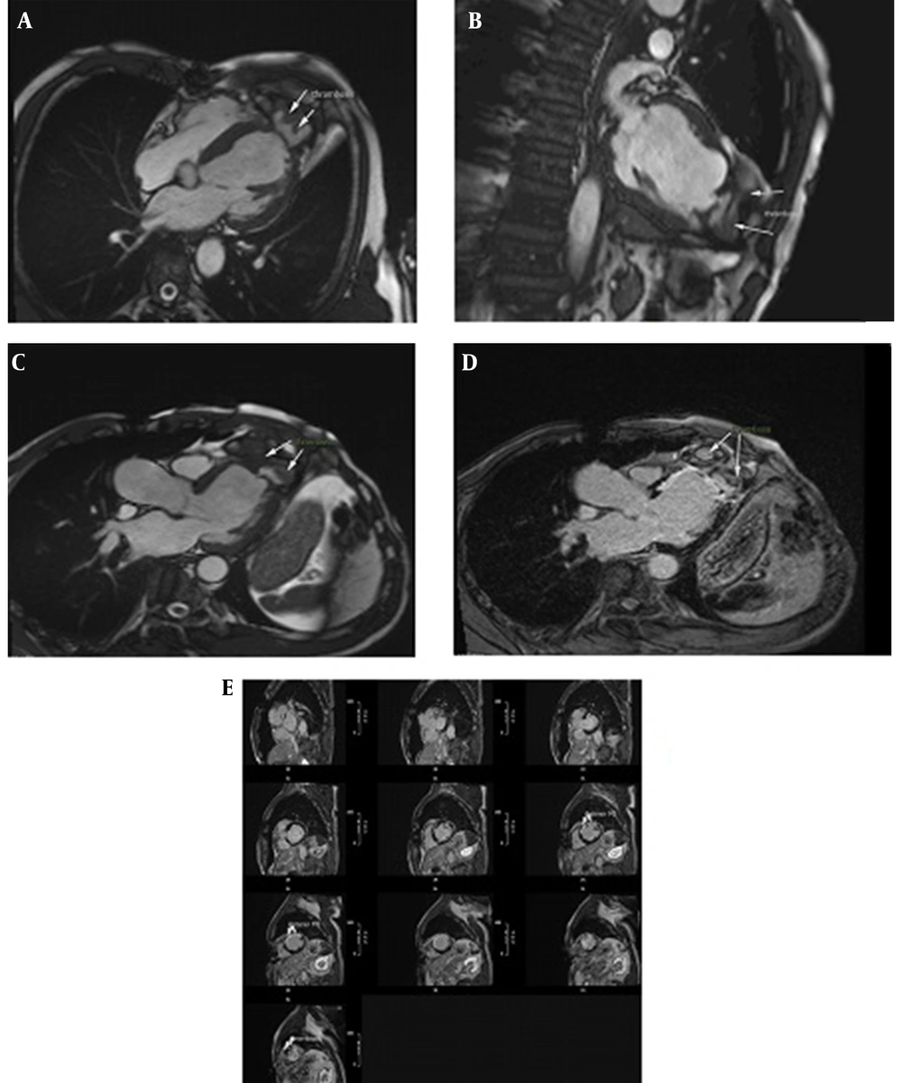 Recurrent Left Ventricular Apical Pseudoaneurysm at the Site of ...