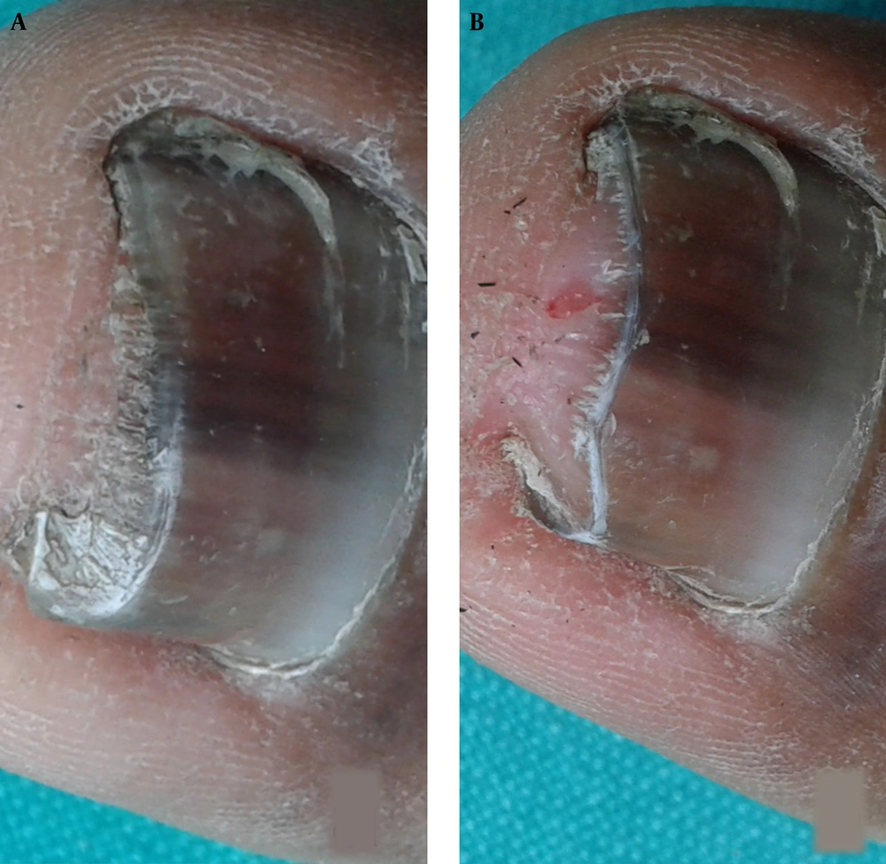 Surgical Pearl: A Simplified Chemical Technique for Splinting Nail and ...