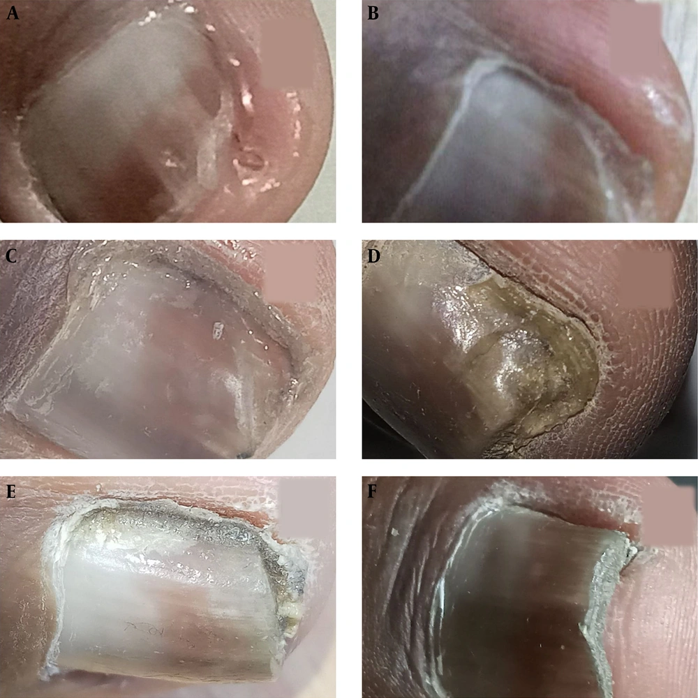 Surgical Pearl: A Simplified Chemical Technique for Splinting Nail and ...