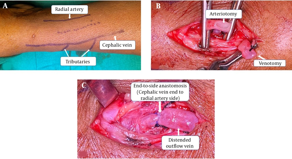 Evaluation of Factors Affecting Wrist Radio-Cephalic Arteriovenous ...