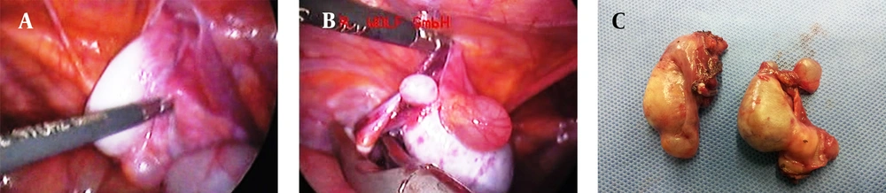 Bilateral Laparoscopic Gonadectomy in a Patient With Complete Androgen ...