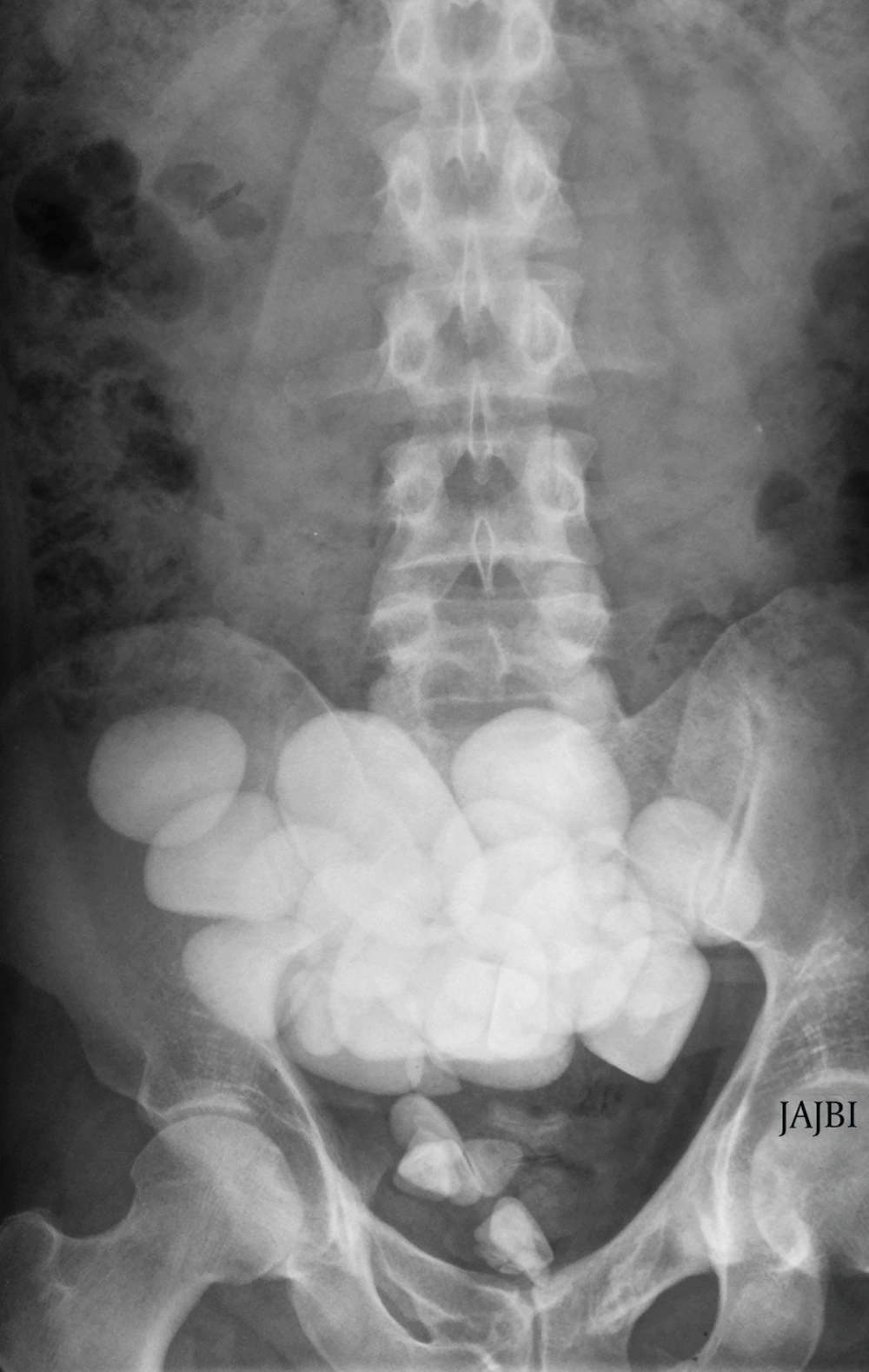 Massive Vesical Calculi Formation as a Complication of Augmentation ...