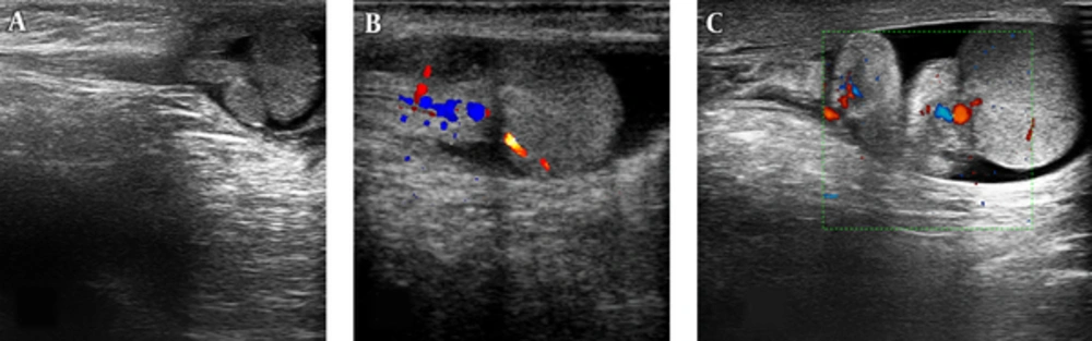 Epididymal or Testicular Ultrasonic Findings: Which One is More ...