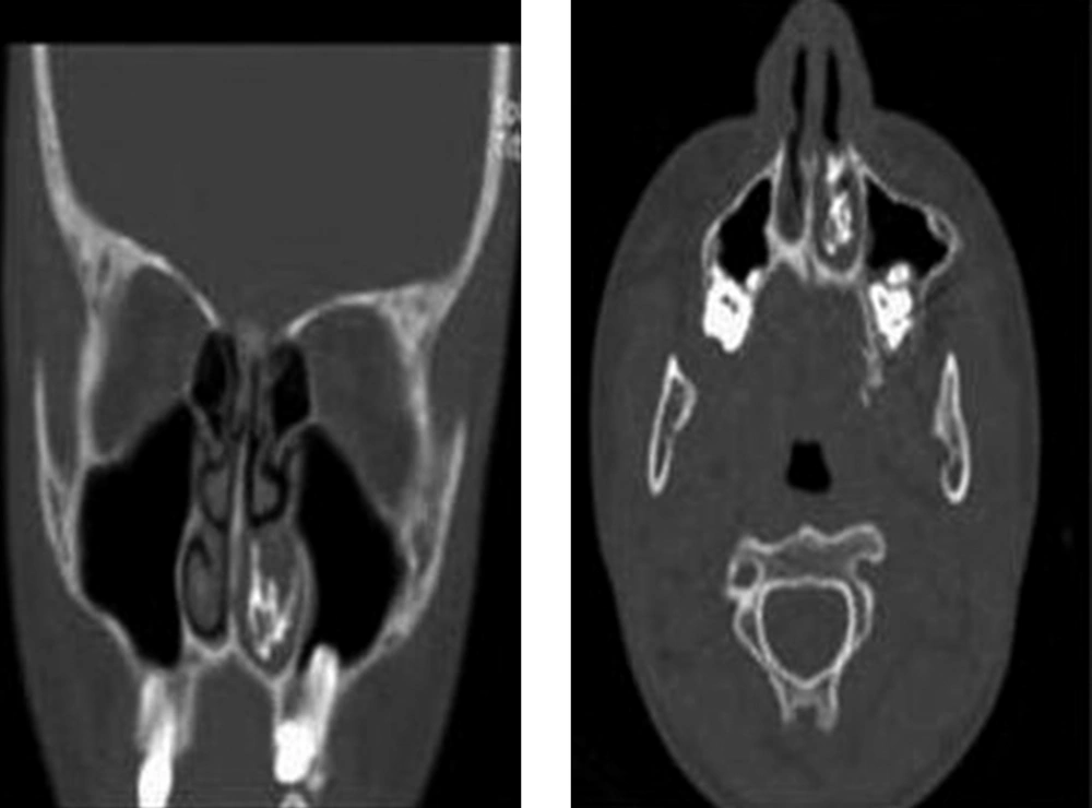 Rhinolith in a 13-Year-Old Boy: a Case Report of a Rare Condition